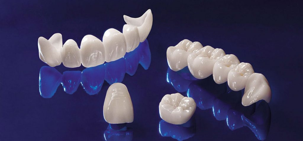 Dental Crowns and Bridges - Sunrise Village Dental Clinic on Hastings St.