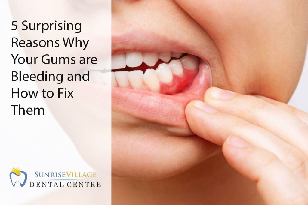 5 Surprising Reasons Why Your Gums are Bleeding and How to Fix Them ...